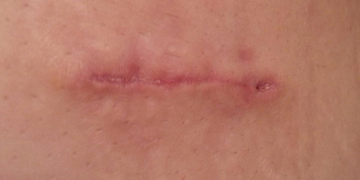 Scar treatment - My results - Photos included - Gastric Sleeve Surgery ...