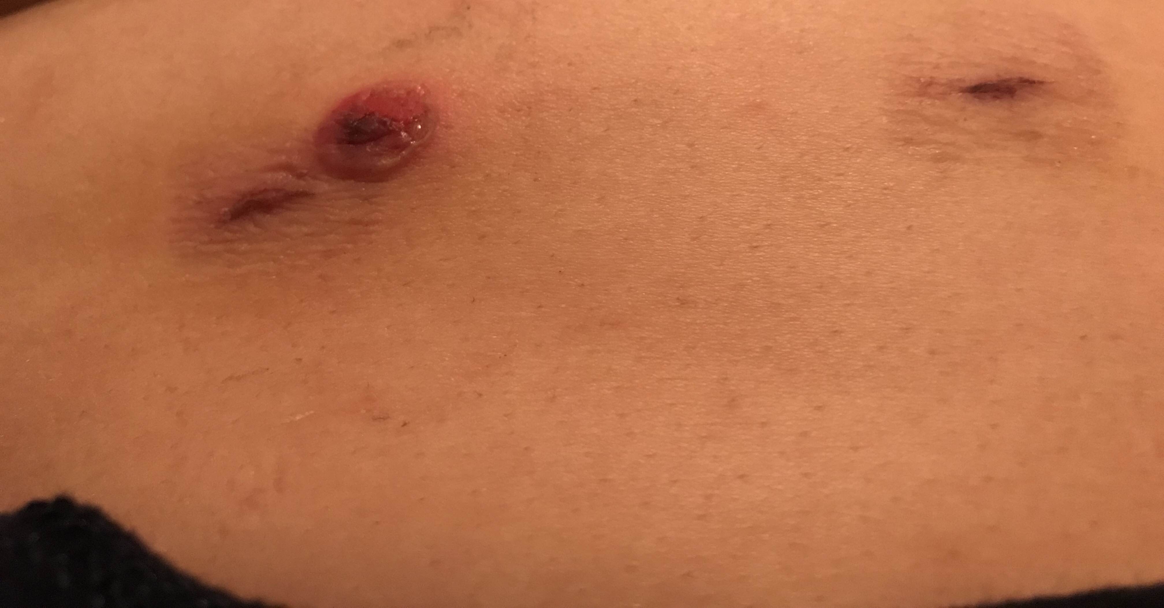 Blister with fluid - POST-Operation Weight Loss Surgery Q&A - BariatricPal