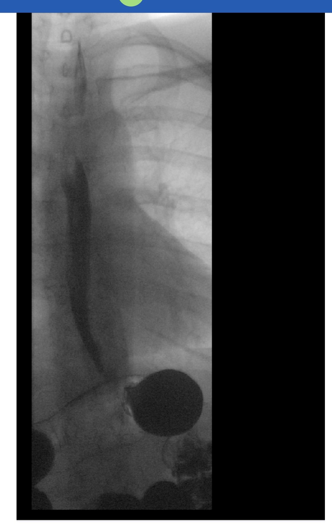 9 months out-VSG Fundus Complications - Revision Weight Loss Surgery ...