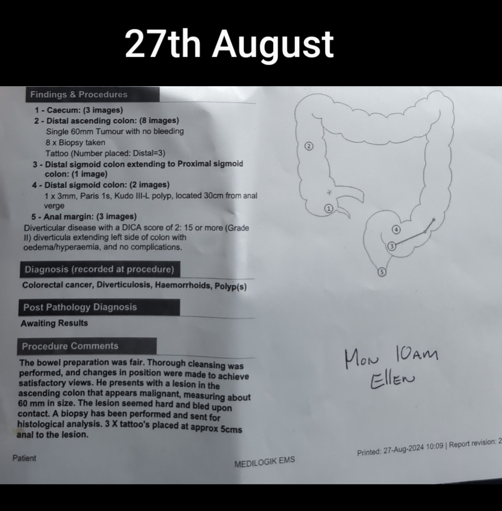 Diagnosed at colonoscopy - then false negative biopsies? - Just ...