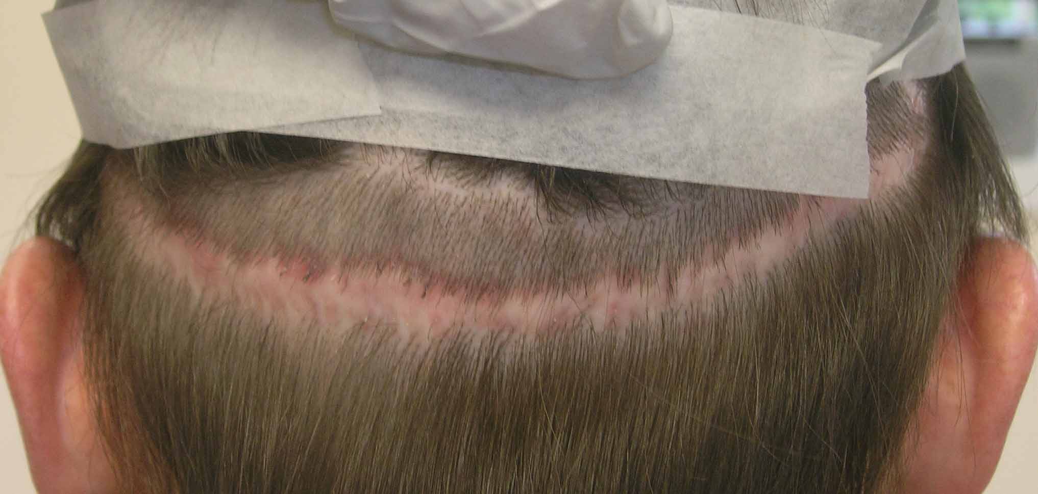 DHI nightmare Scar fixed by Dr. Lindsey - Hair Transplant Reviews ...
