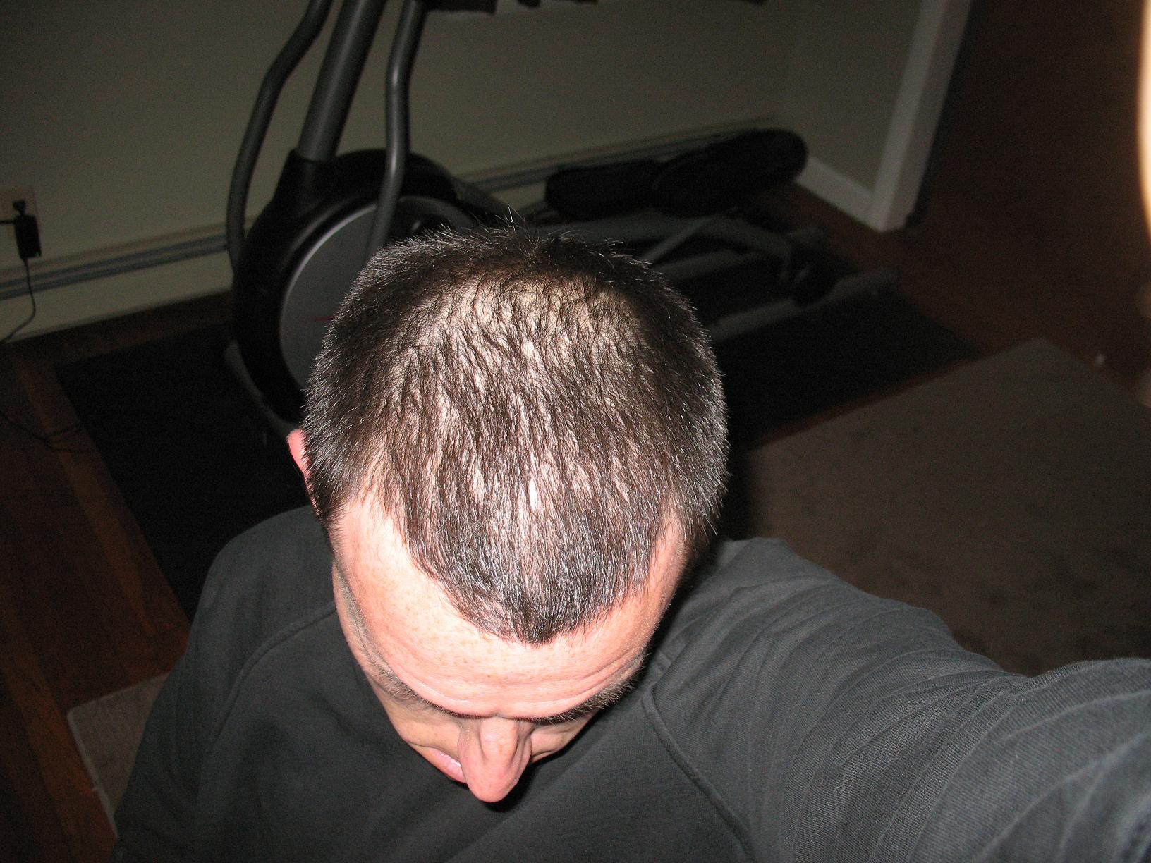 First PRP treatment in New York-Dr. Alan Feller - Open Hair Loss Topics ...