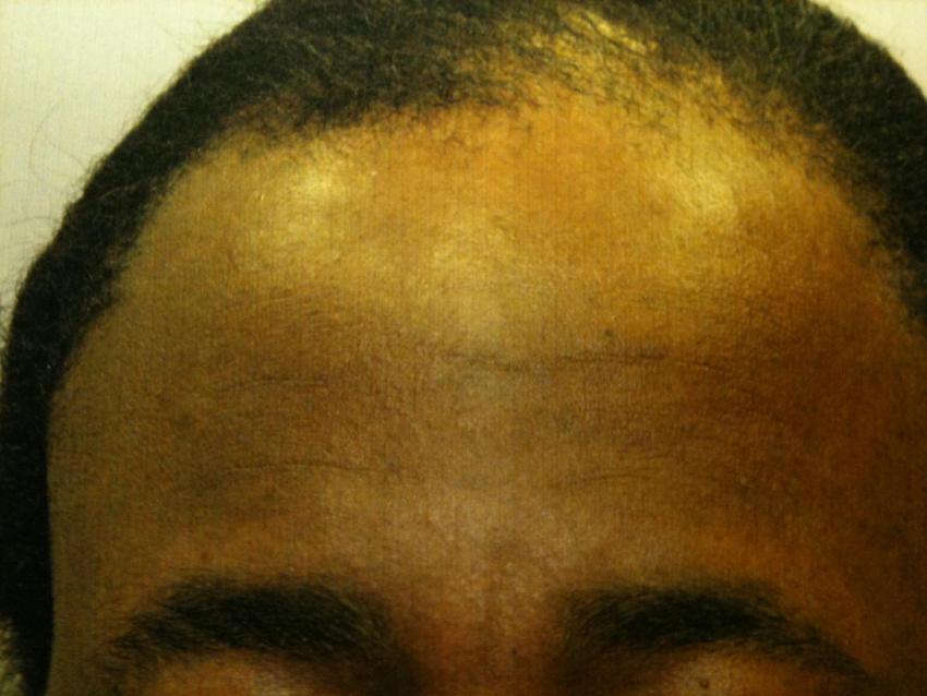 Dr. yates/chicago/Bosley: Beautiful Work!! - Hair Transplant Reviews ...