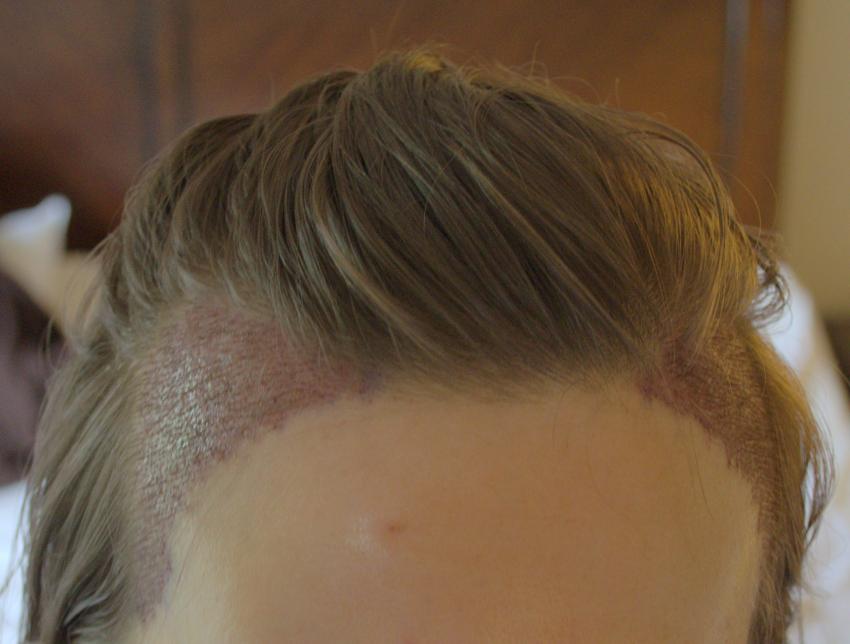 Dr. Steven Gabel - 2349 Grafts FUSS - Female Patient - Hair Transplant ...