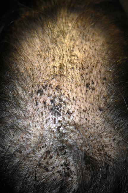 The Bosley Experience - Hair Transplant Reviews - Hair Restoration ...