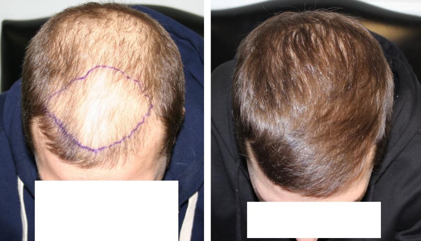 Dr. Feller patient 3 years after procedure - Results Posted by Leading ...