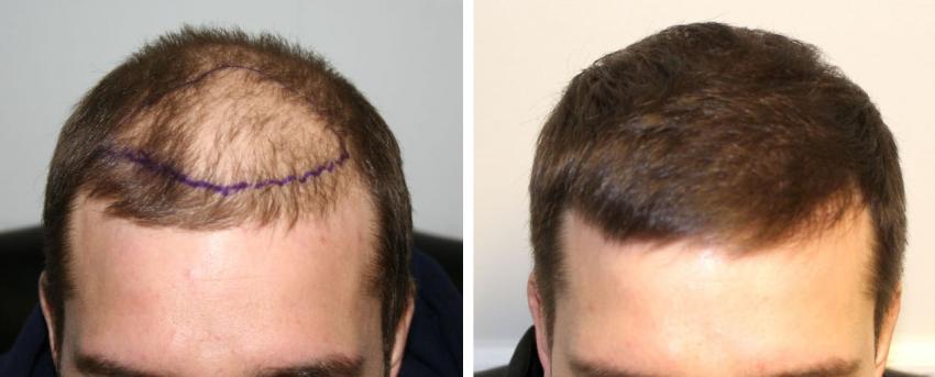 Dr. Feller patient 3 years after procedure - Results Posted by Leading ...