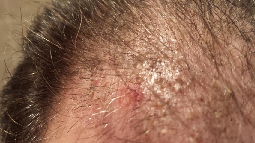 Did I dislodge a graft??? - Hair Restoration Questions and Answers ...