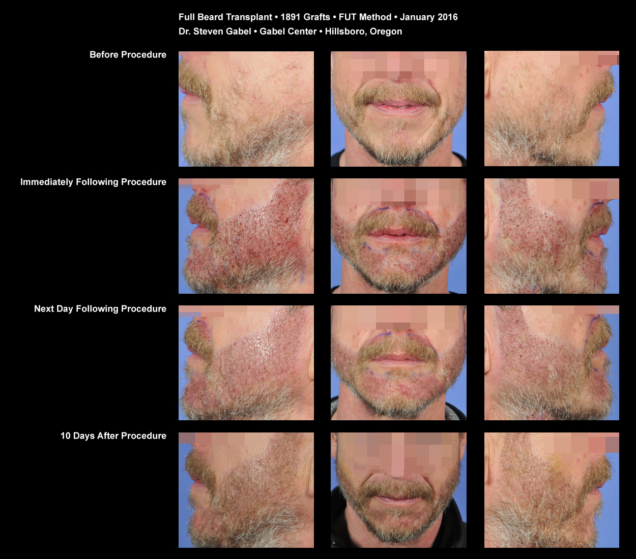Full Beard Transplant, 1891 Grafts, FUT - Hair Transplant Reviews ...