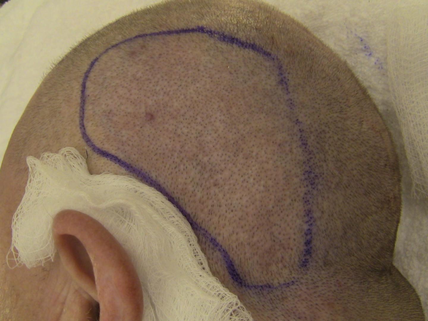 Is buzzing head a possibility after FUE HT? - Hair Transplant Reviews ...