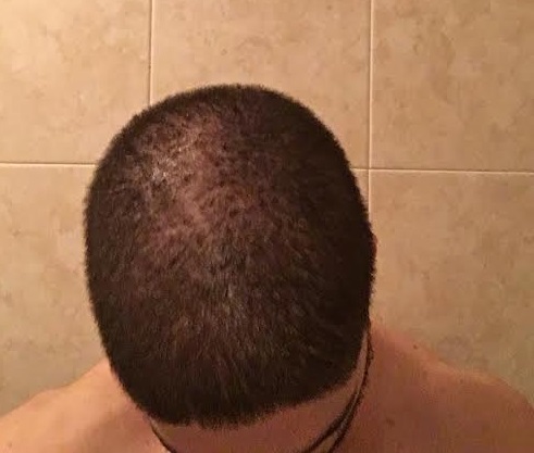 NW0/NW1 but thinning up top - Hair Restoration Questions and Answers ...