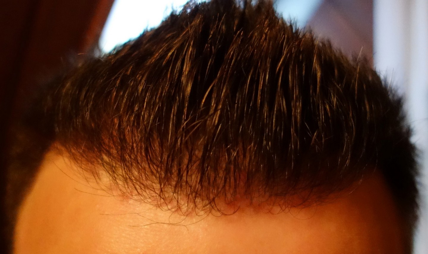 Temporal point looks very unnatural after FUE - advice needed - Hair ...