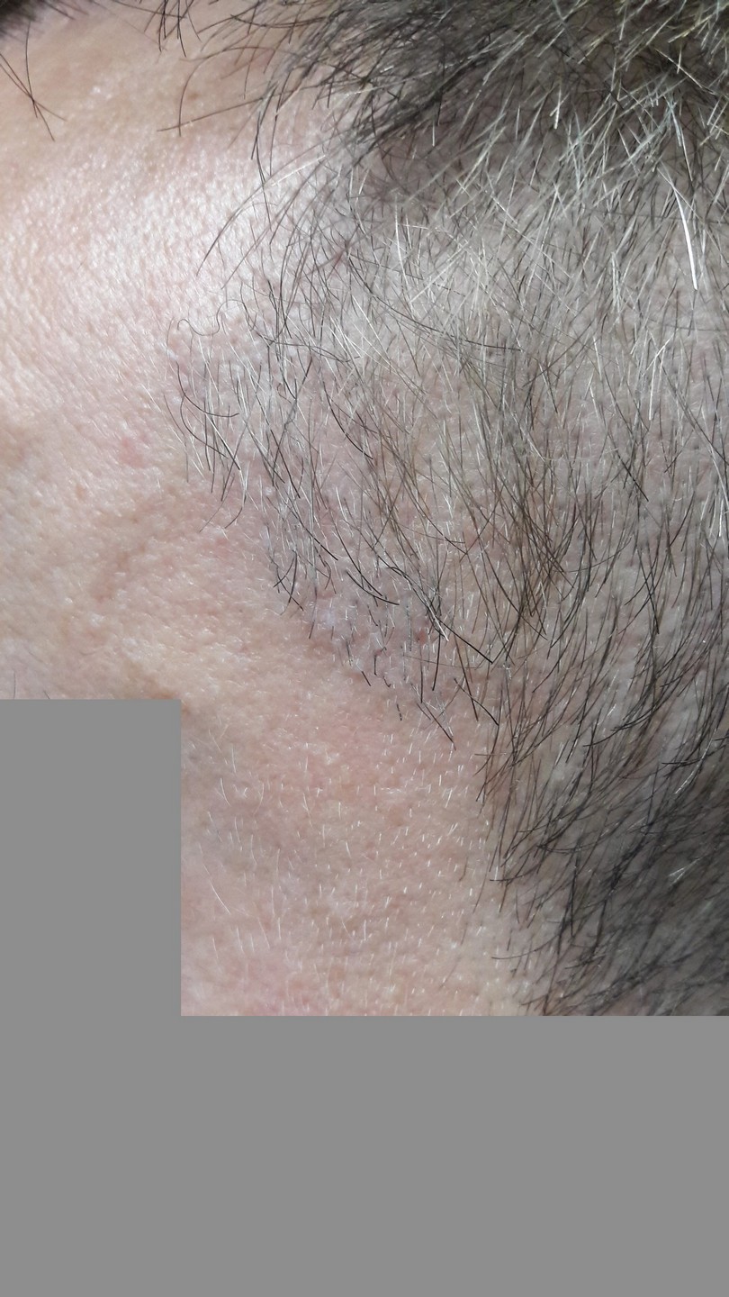 Temporal point looks very unnatural after FUE - advice needed - Hair ...