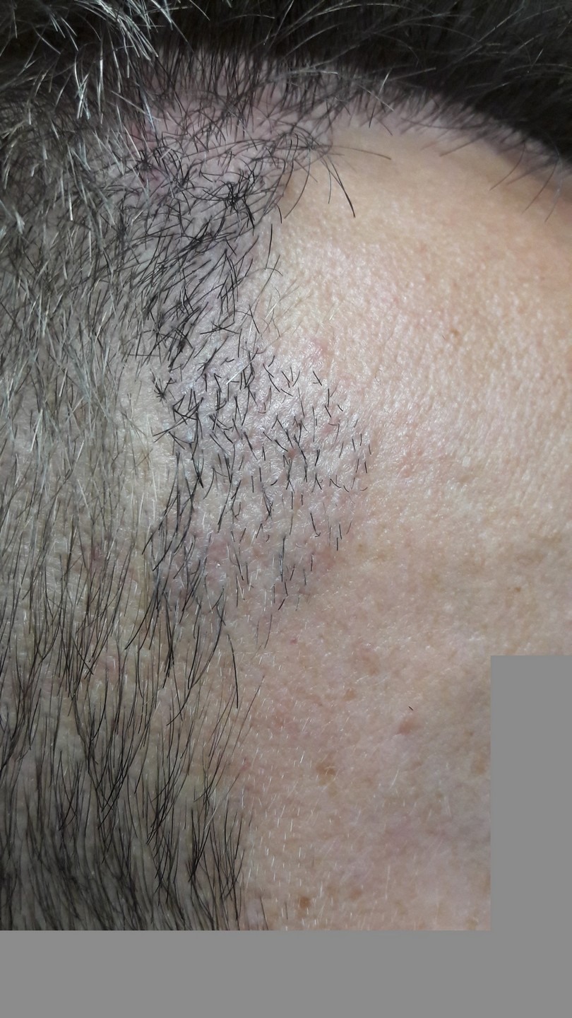 Temporal point looks very unnatural after FUE - advice needed - Hair ...
