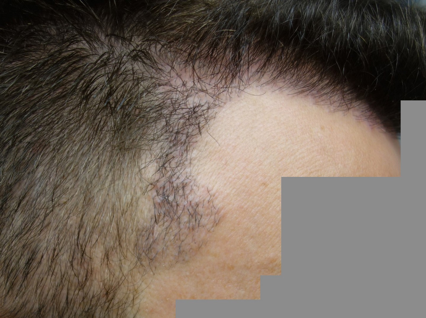 Temporal point looks very unnatural after FUE - advice needed - Hair ...