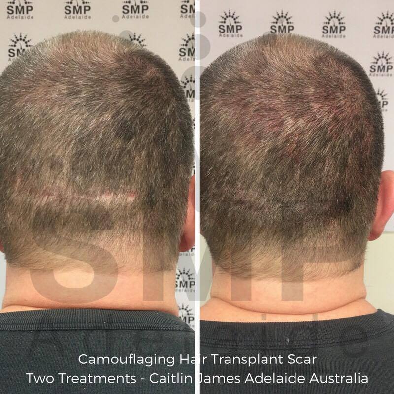 Strip scar repair. It is possible - Hair Restoration Questions and ...