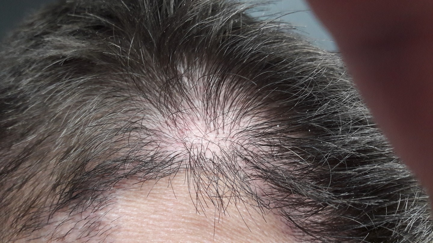 Temporal point looks very unnatural after FUE - advice needed - Hair ...