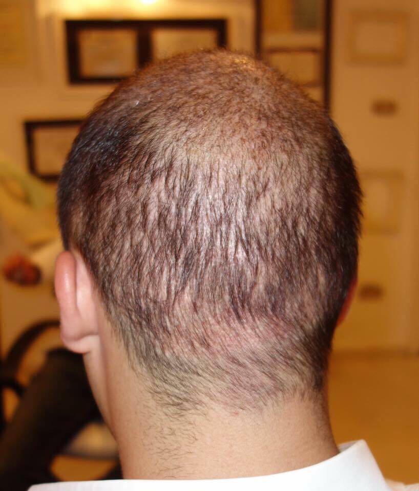 The pros/cons of FUE. Myths dispelled. - Hair Transplant Reviews - Hair ...
