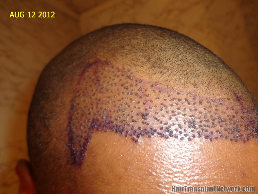 Disaster - Hair Restoration Network - Forum For and By Hair Loss Patients