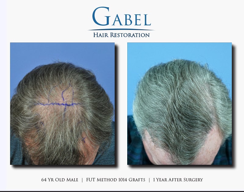 hair transplants oregon - Hair Restoration Network - Forum For and By ...