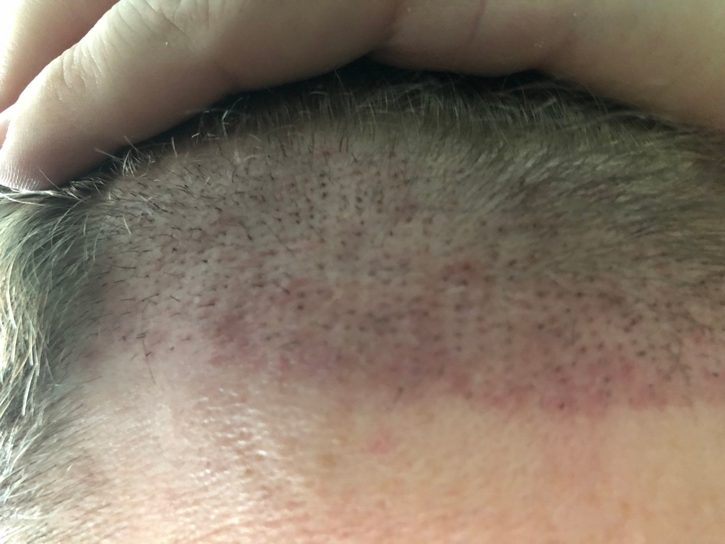 8 weeks to 15 weeks difference! - Hair Transplant Reviews - Hair ...