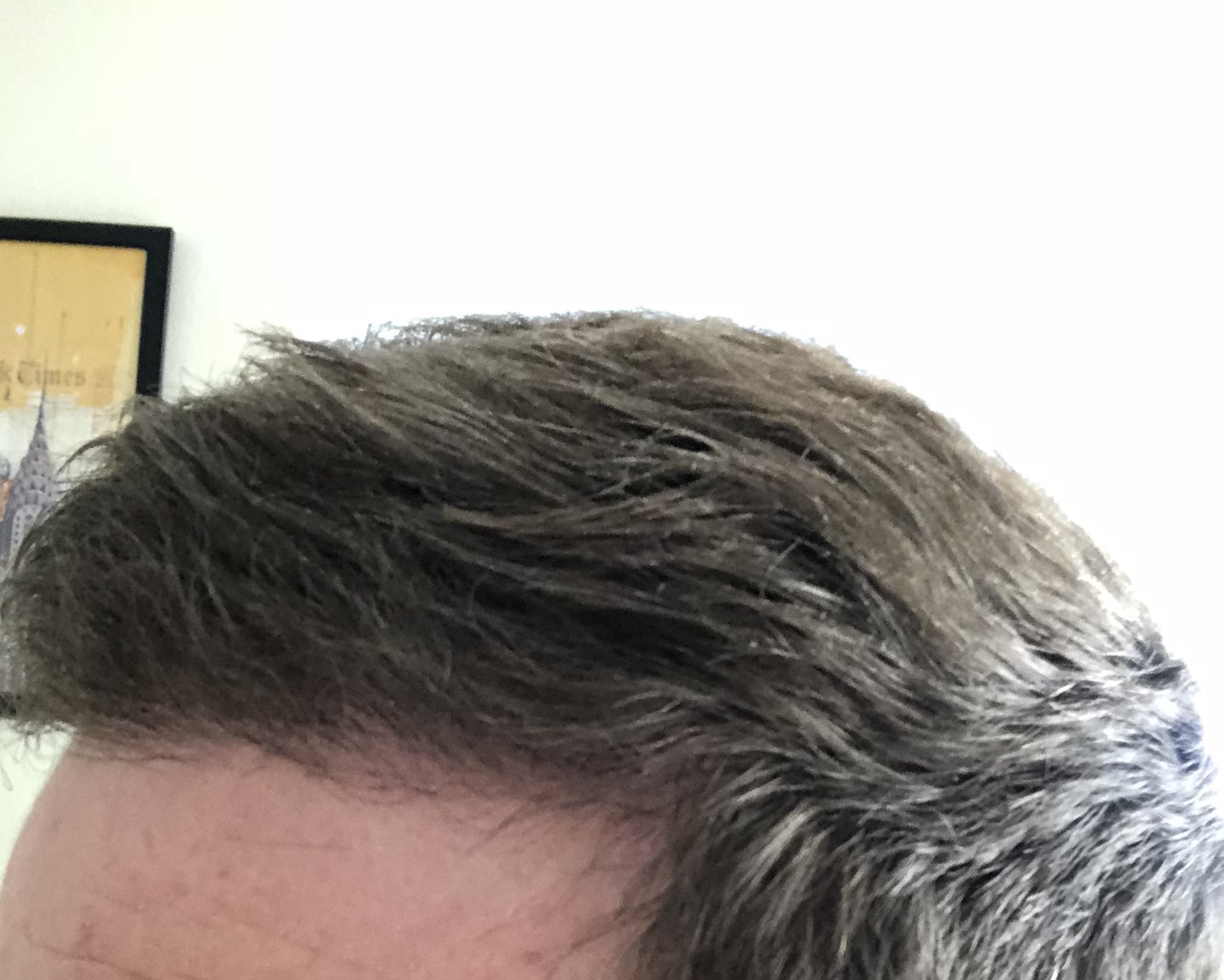 8 weeks to 15 weeks difference! - Hair Transplant Reviews - Hair ...