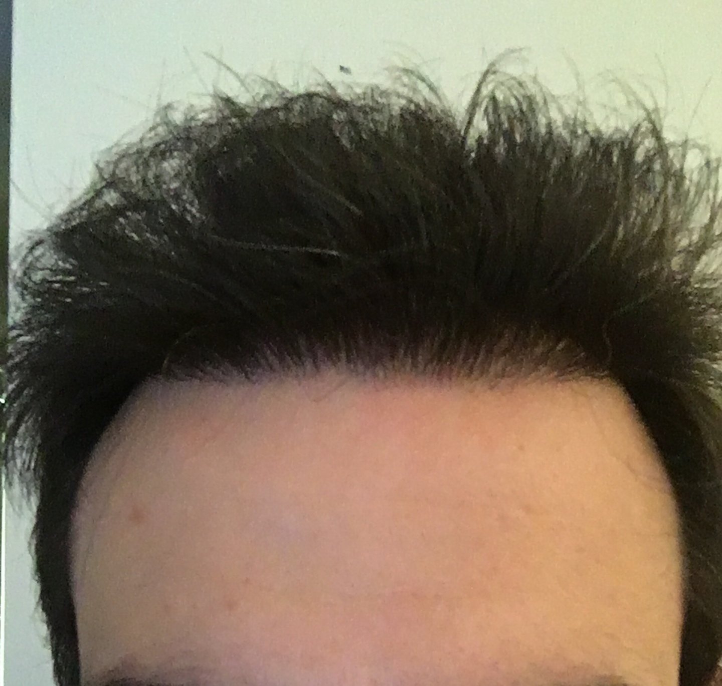 Are Hair Transplants an “Illusion” of density? - Hair Restoration ...