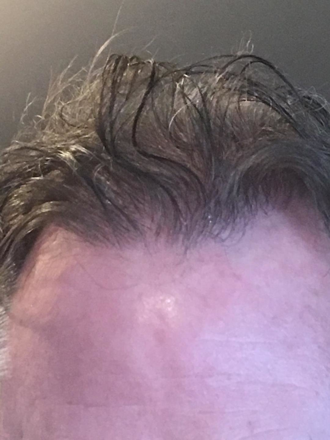 2,614 Grafts with Dr Bloxham at Feller & Bloxham, Oct 2017 - Hair ...
