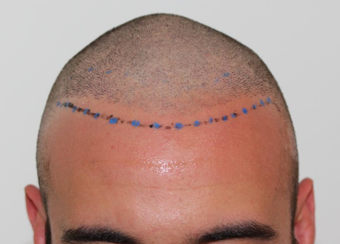 BHT for shaved head look - Hair Restoration Questions and Answers ...