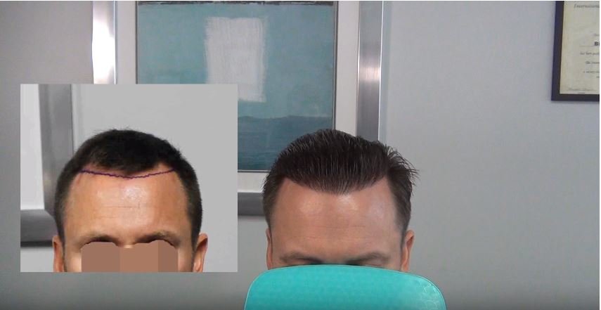 Hairlines: Not a "One Size Fits All" | Dr. Bloxham | 2,400 Grafts ...