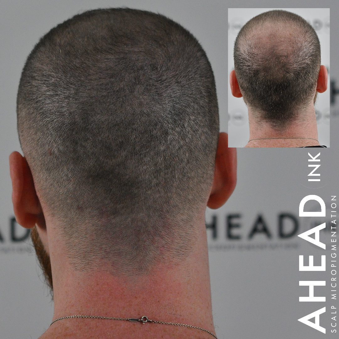 SMP For Crown Work - Scalp Micropigmentation (SMP) - Hair Restoration ...