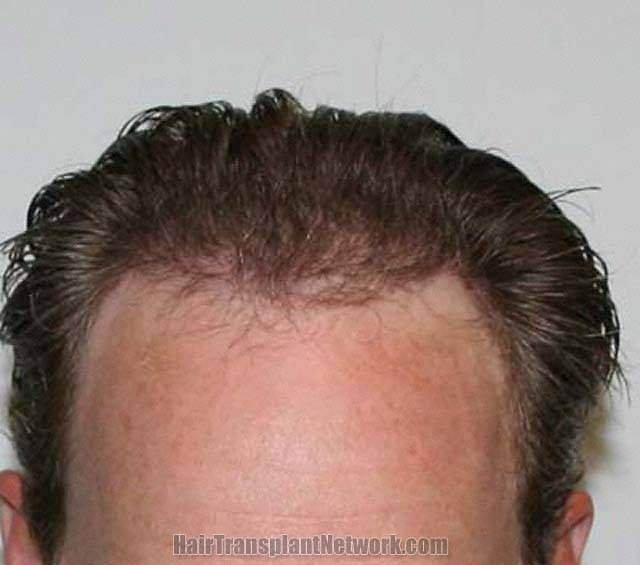 Dr. Feller - 2000 Grafts at 4 Months - Results Posted by Leading Hair ...