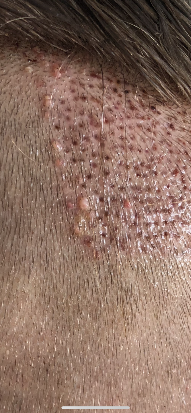 Possible Keloid Scarring in FUE Donor Zone (What can I do to get them ...