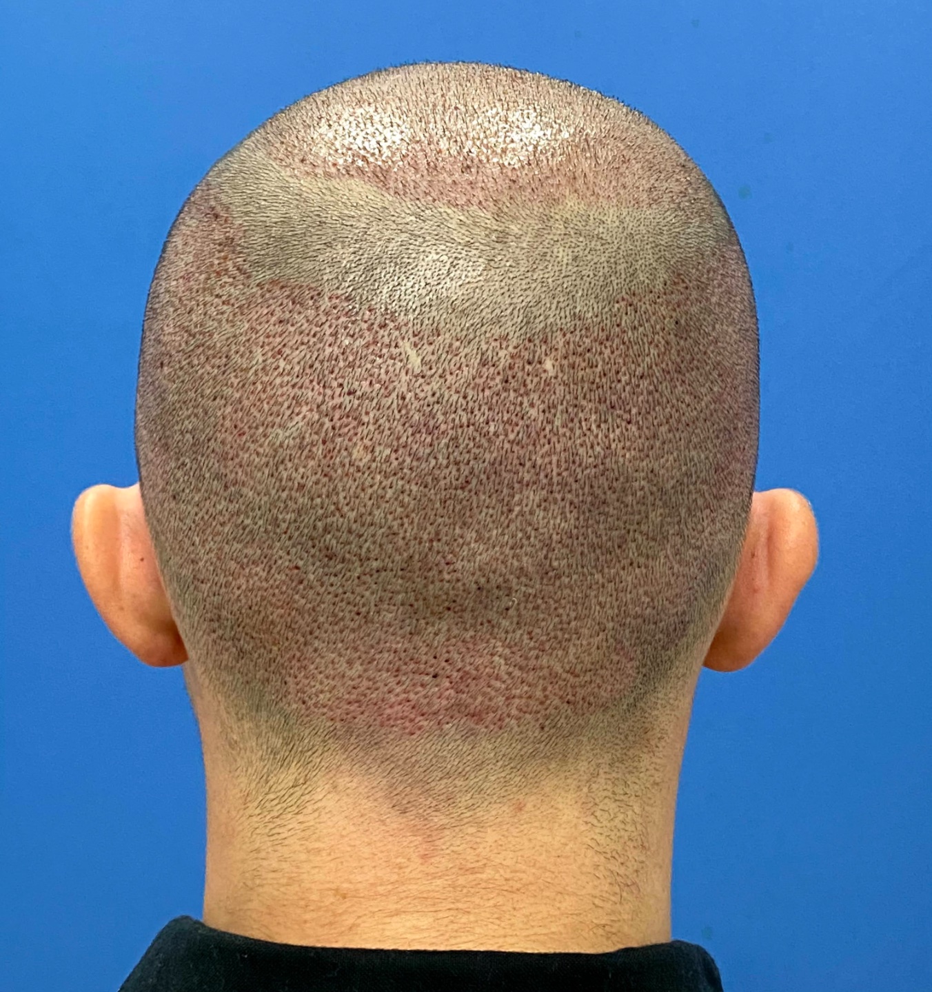 5020 FUE Scars - Shaved down with blade - Hair Transplant Reviews ...