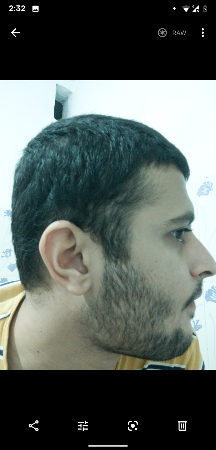 Topical Finasteride and minoxidil solution for Diffuse thinning and ...