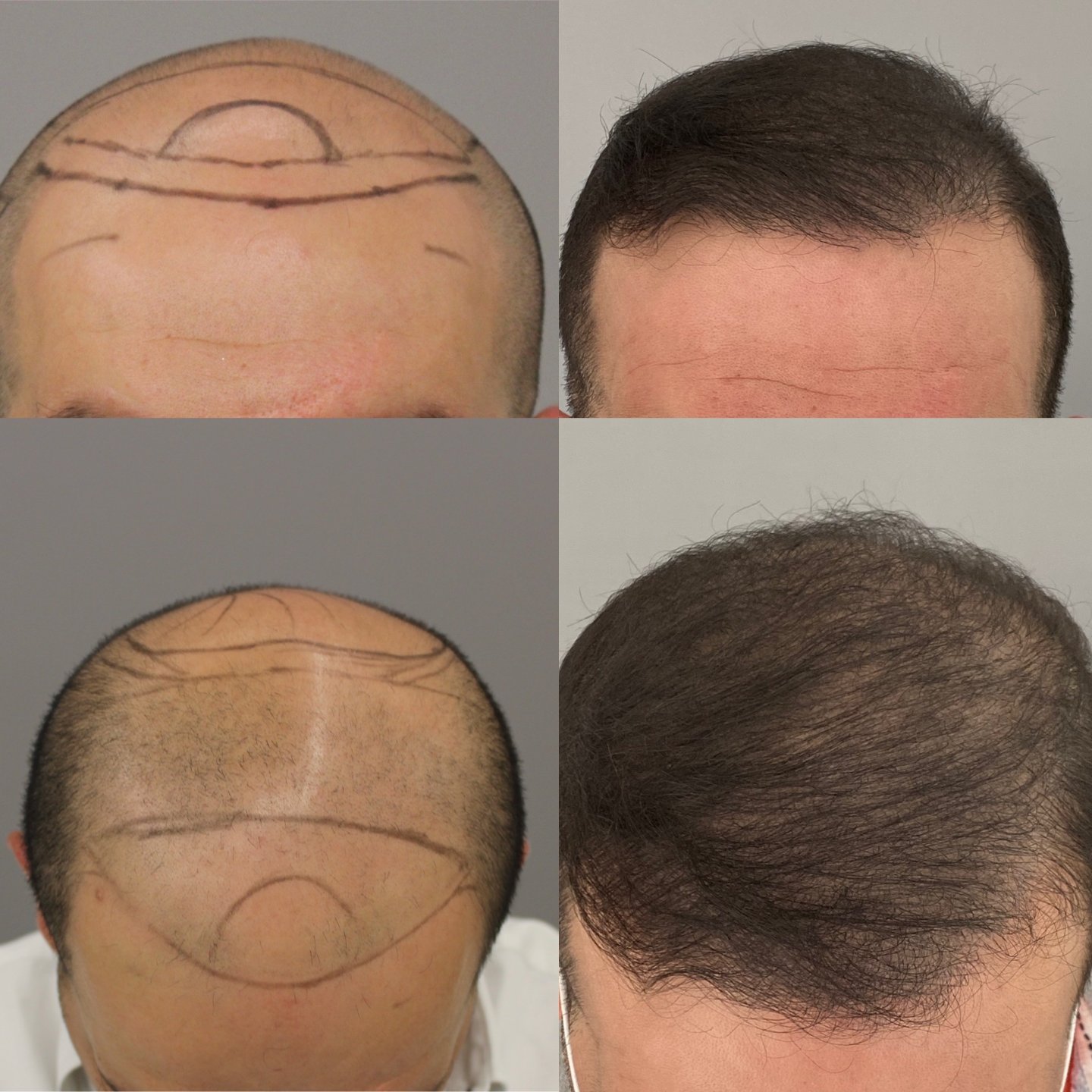 4620 NW7 FUE. Dr. Taleb Barghouthi- Vertex Hair Clinic - Results Posted ...