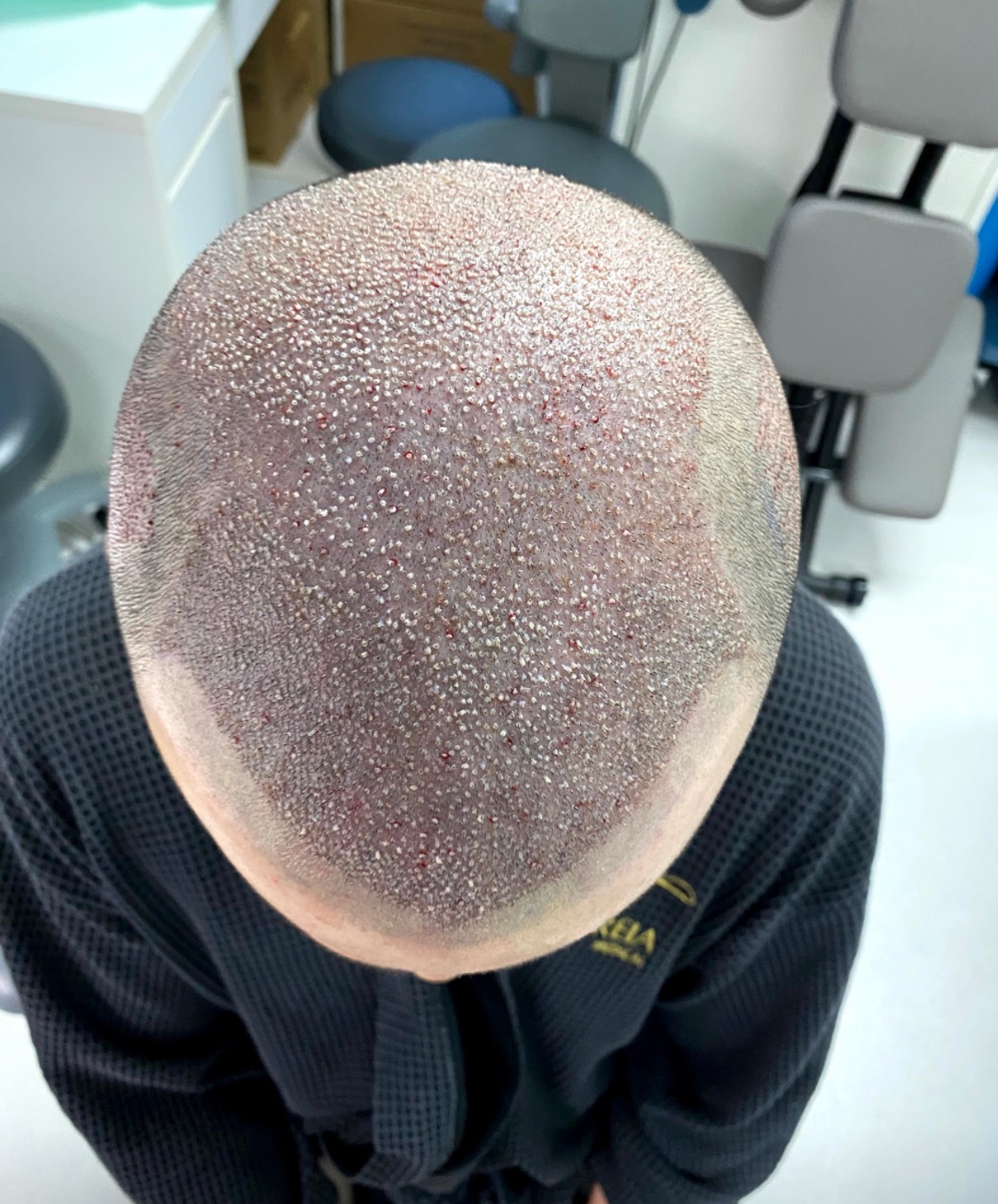 5020 FUE Scars - Shaved down with blade - Page 2 - Hair Transplant ...