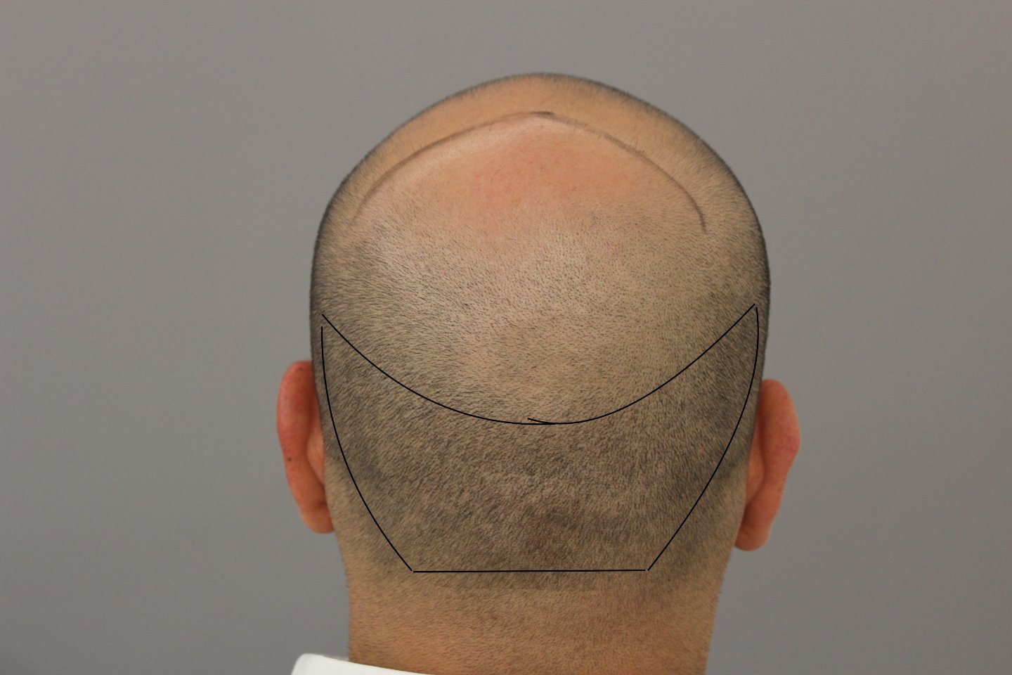 4620 NW7 FUE. Dr. Taleb Barghouthi- Vertex Hair Clinic - Results Posted ...