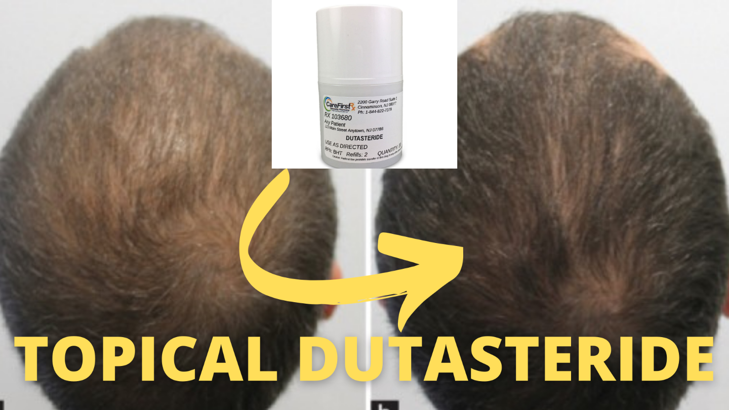 Topical Dutasteride Effective For Hair Loss? - Hair Loss Drugs - Hair ...