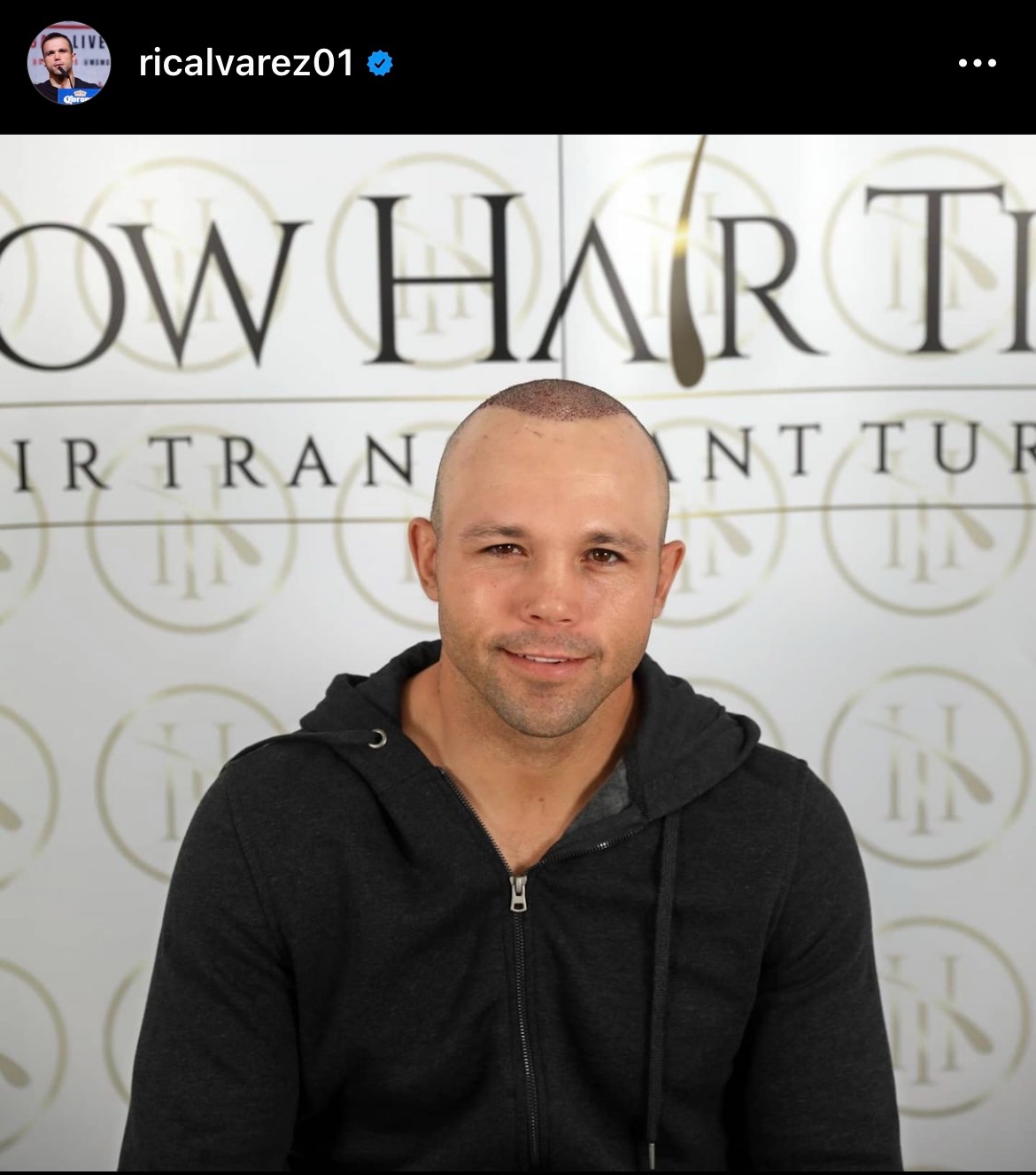 Canelo Alvarez’s Brother Gets a Hair Transplant - Hair Transplant ...