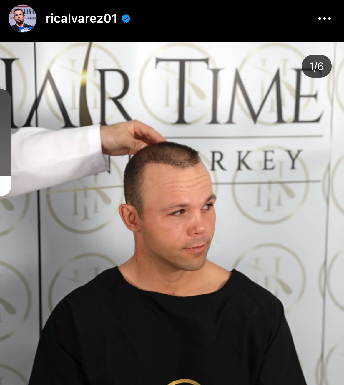Canelo Alvarez’s Brother Gets a Hair Transplant - Hair Transplant ...
