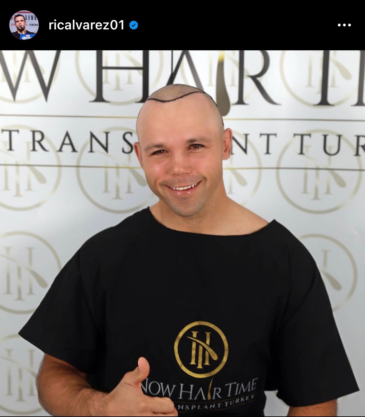 Canelo Alvarez’s Brother Gets a Hair Transplant - Hair Transplant ...