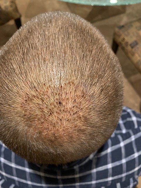 Crown Growth Timeline Help - Hair Restoration Questions and Answers ...