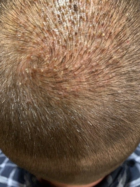 Crown Growth Timeline Help - Hair Restoration Questions and Answers ...