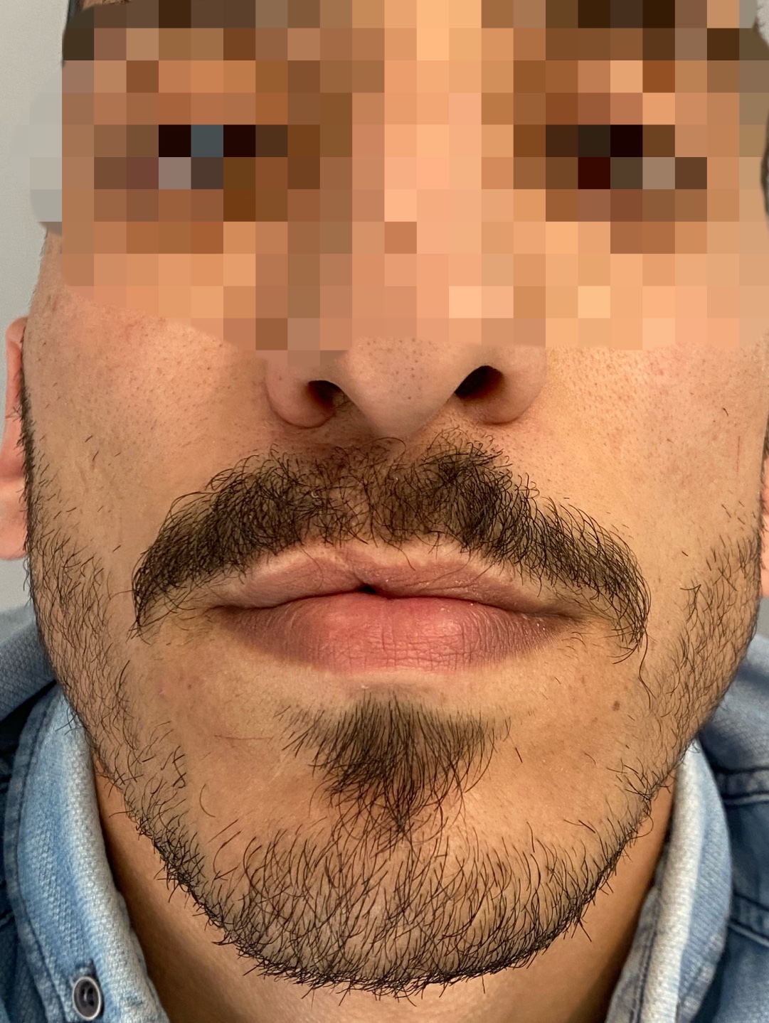 Cleft Lip transplant- Dr. Taleb Barghouthi- Vertex Hair clinic ...