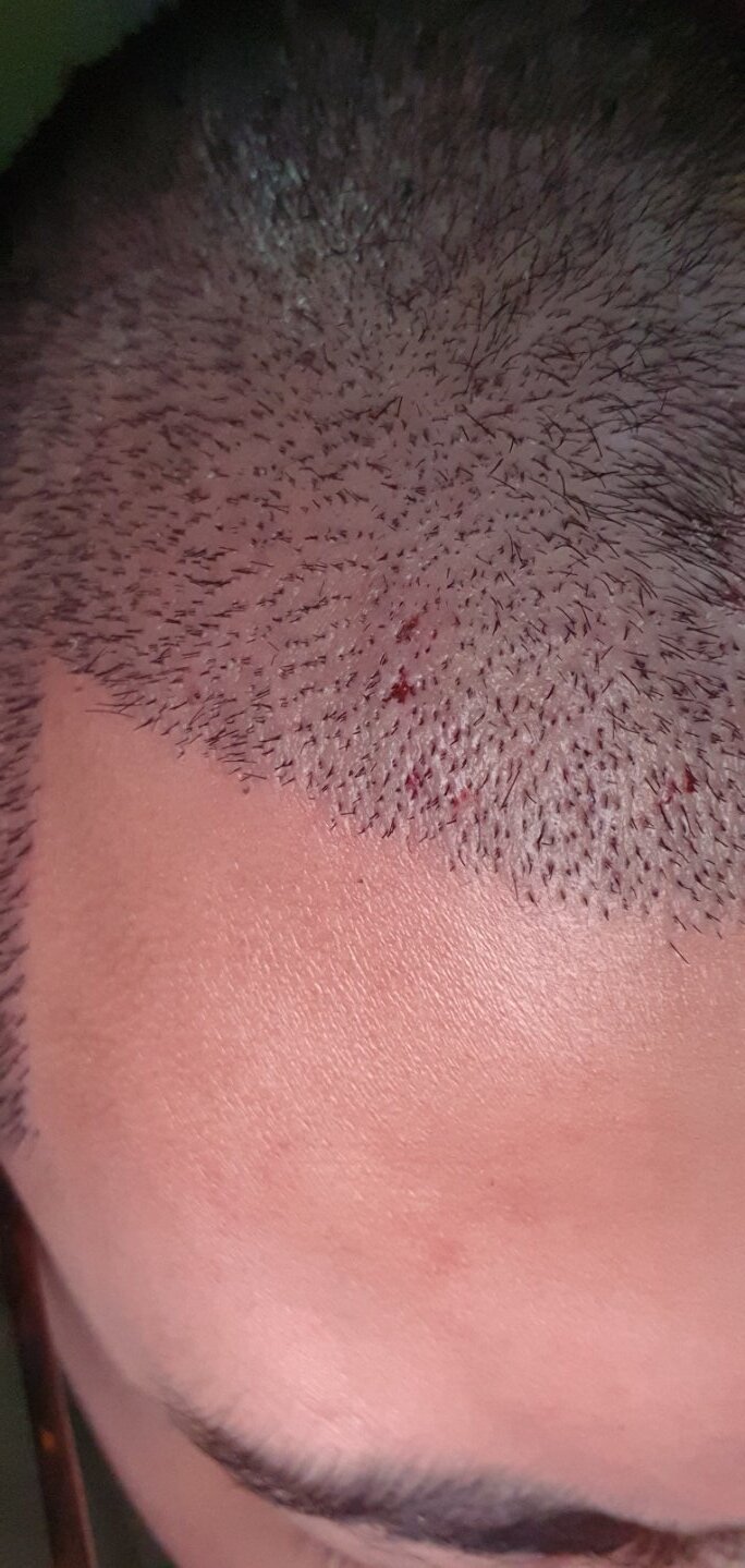 Asymmetrical hairline, hair transplant result, long hair center ...