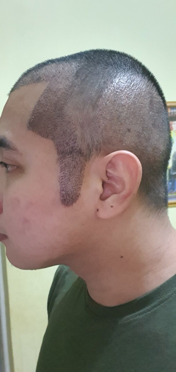 Asymmetrical hairline, hair transplant result, long hair center ...
