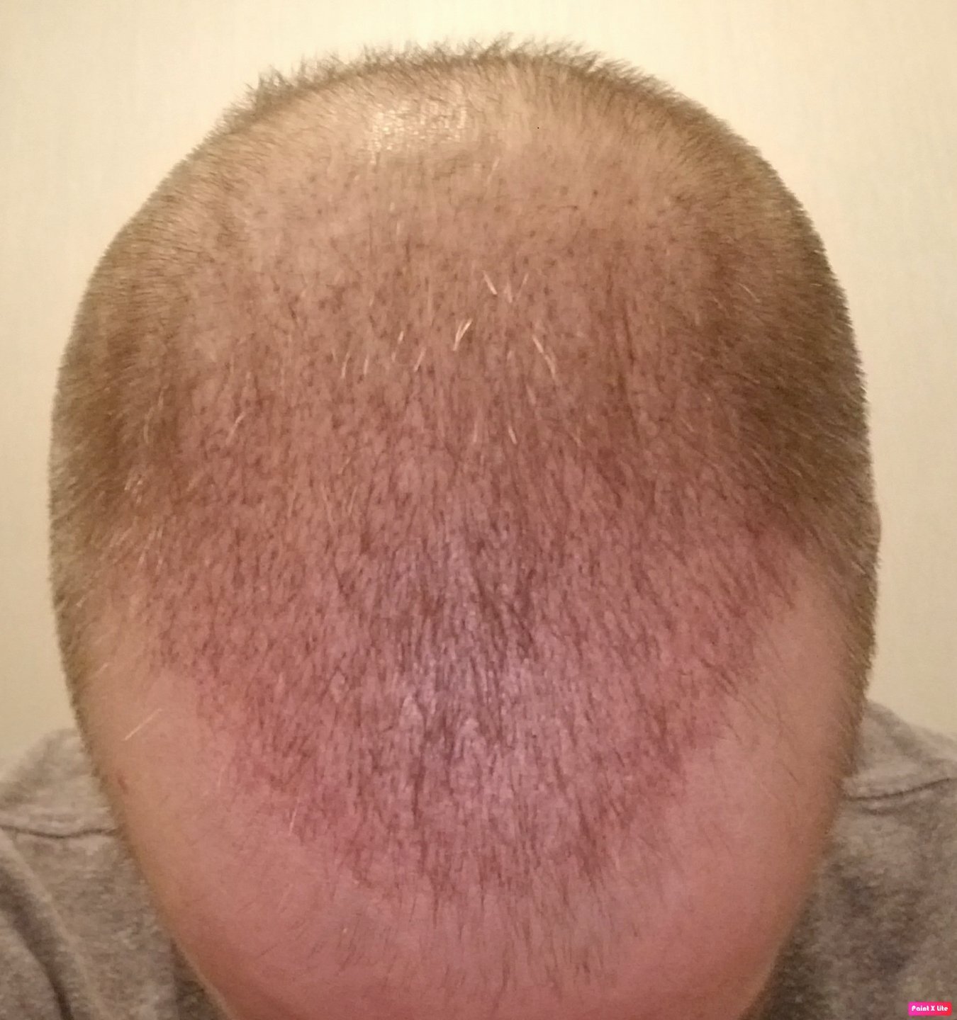 Dr Michael Wolfeld (NYC) review - Hair Restoration Questions and ...