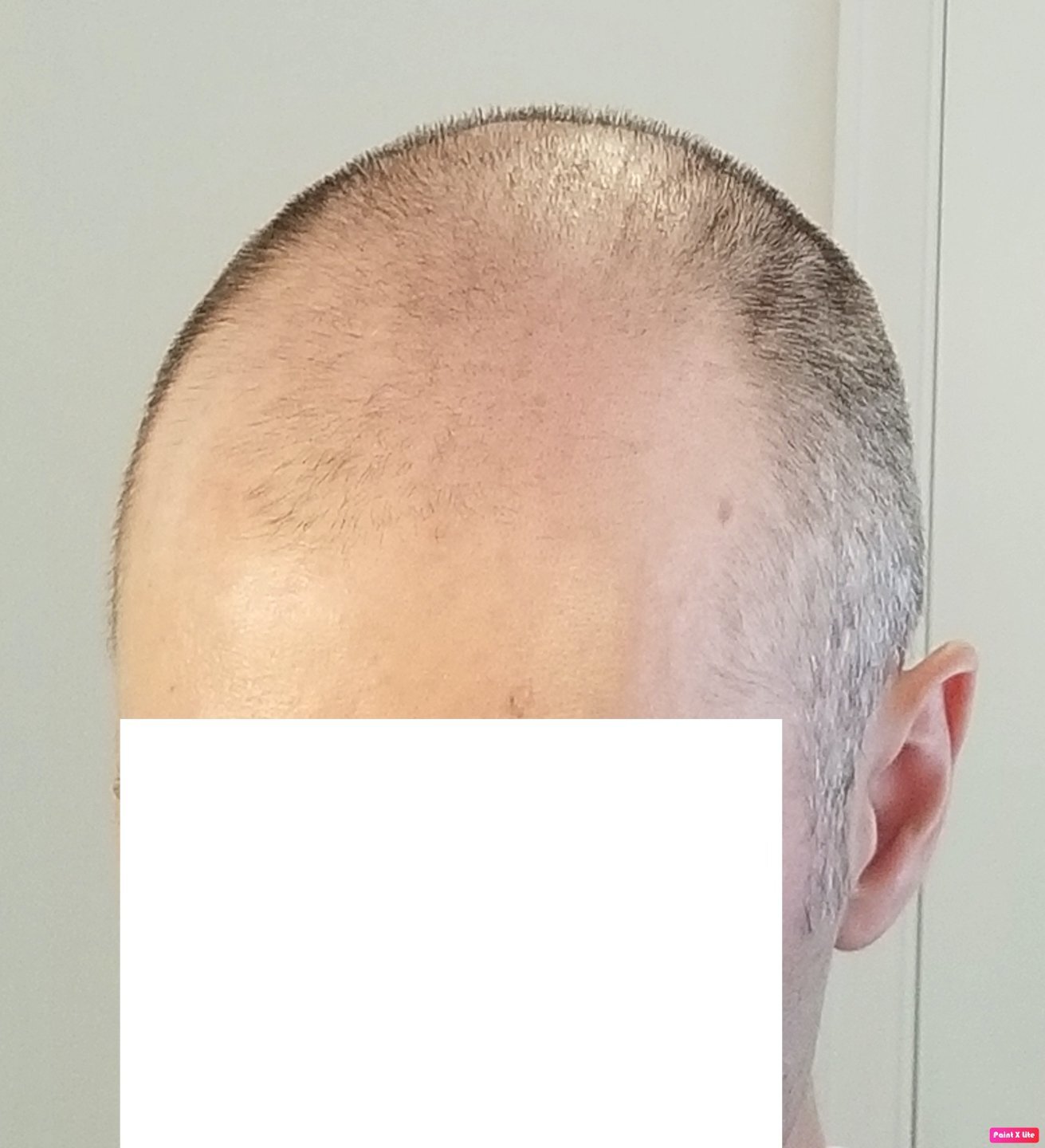 Dr Michael Wolfeld (NYC) review - Hair Restoration Questions and ...
