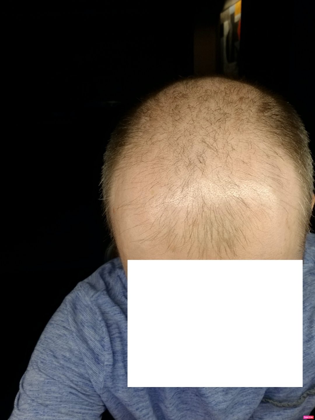 Dr Michael Wolfeld (NYC) review - Hair Restoration Questions and ...